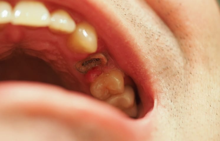 What Happens If You Leave a Broken Tooth Root Untreated?